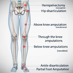 Prosthetics - Motion Orthopedic
